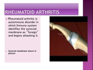 RA-rhemautoid athritis.pptx