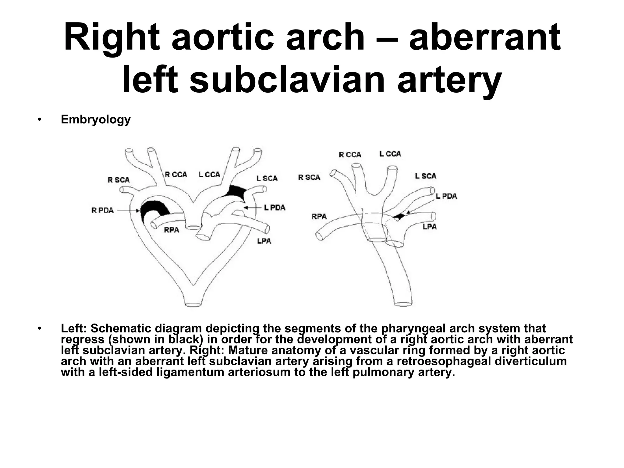 Vascular fetal anomaly -aortic arch anomalies | PPT