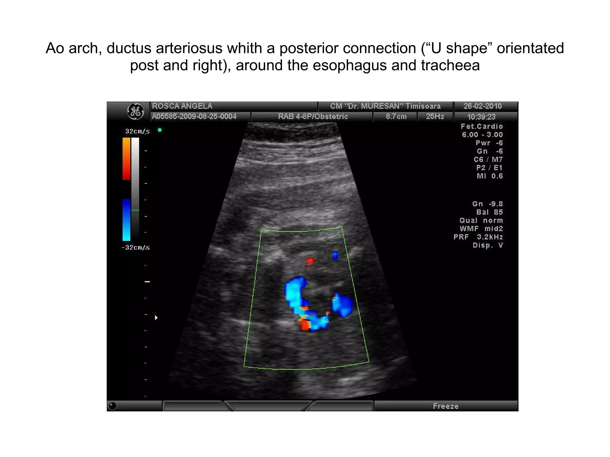 Vascular fetal anomaly -aortic arch anomalies | PPT | Heart and ...