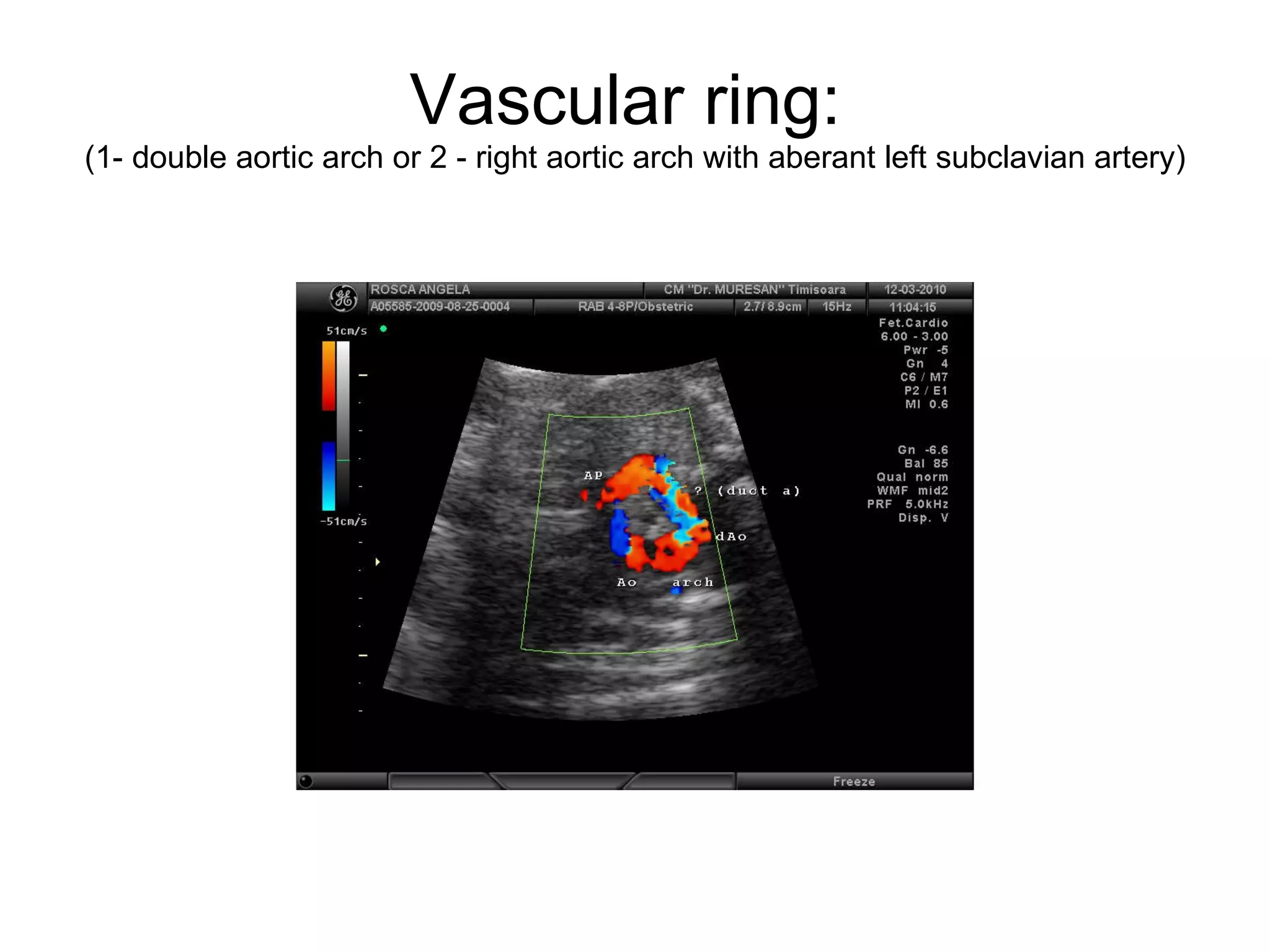 Vascular fetal anomaly -aortic arch anomalies | PPT