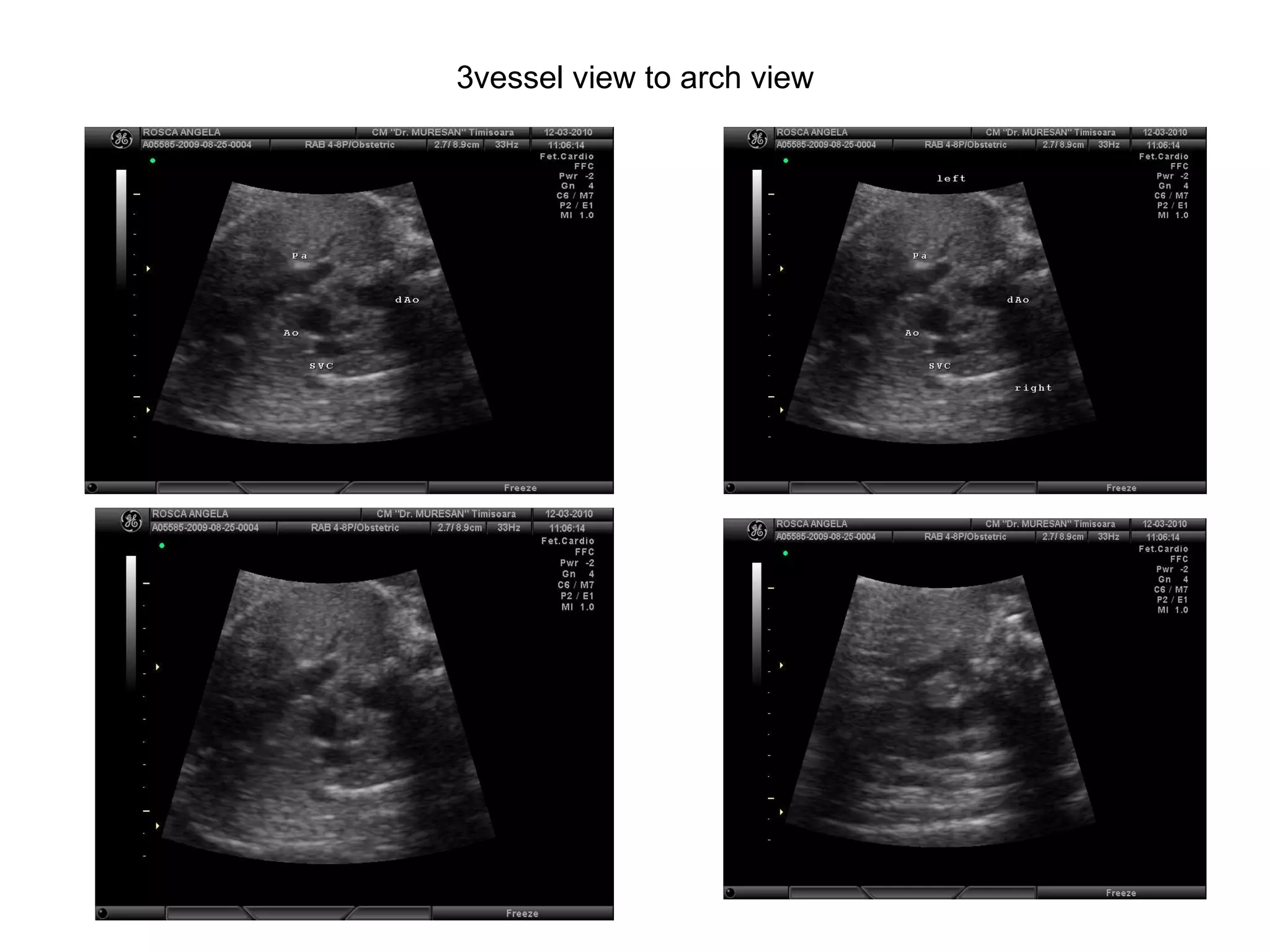 Vascular fetal anomaly -aortic arch anomalies | PPT