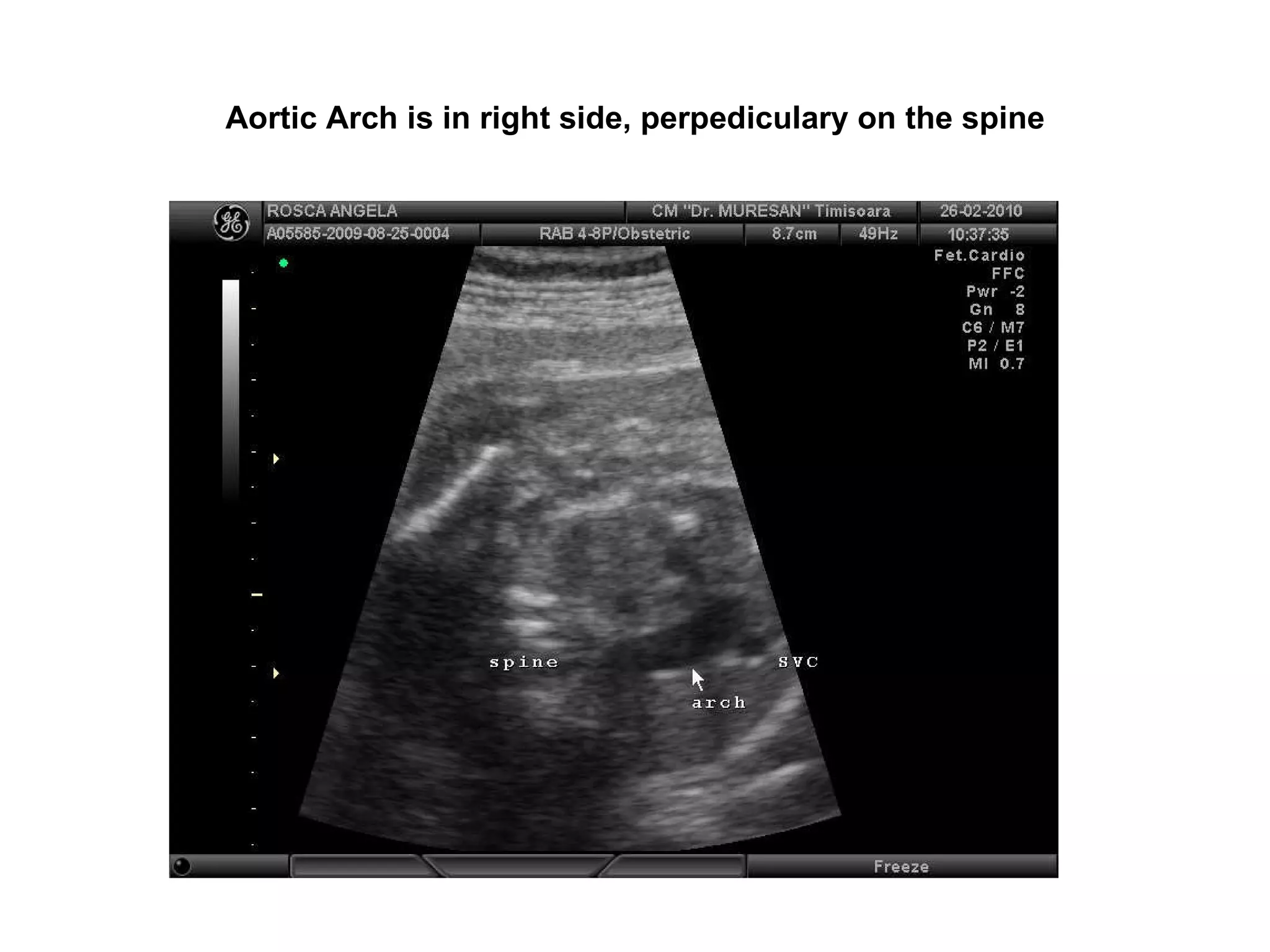 Vascular fetal anomaly -aortic arch anomalies | PPT | Heart and ...
