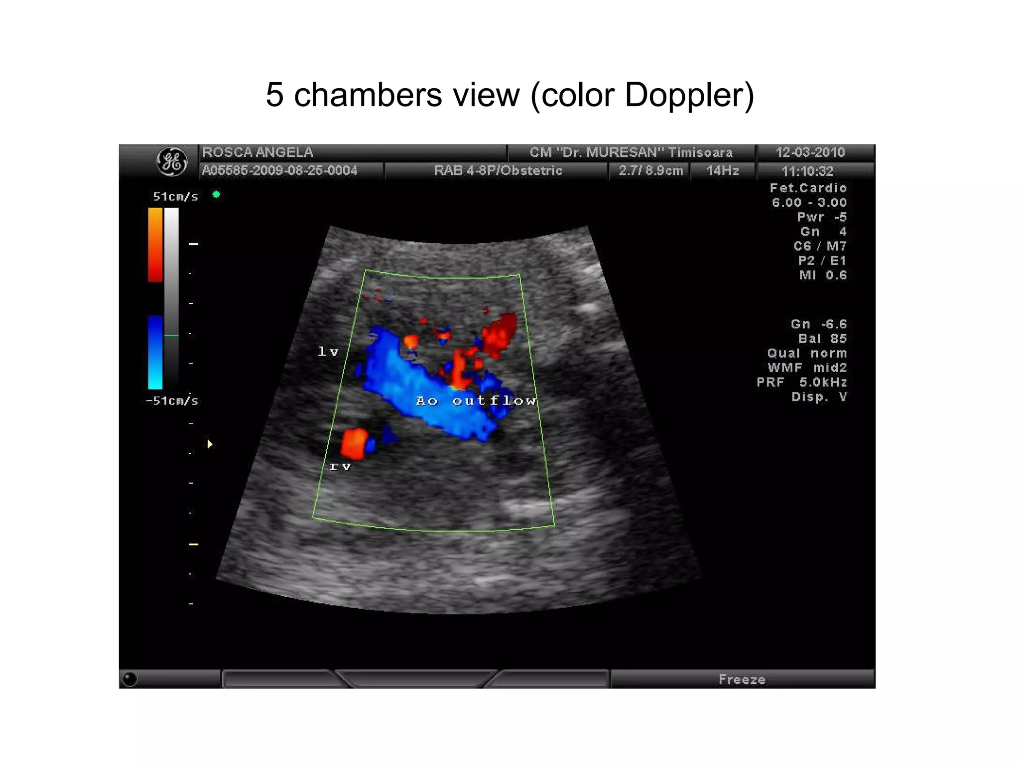 Vascular fetal anomaly -aortic arch anomalies | PPT | Heart and ...