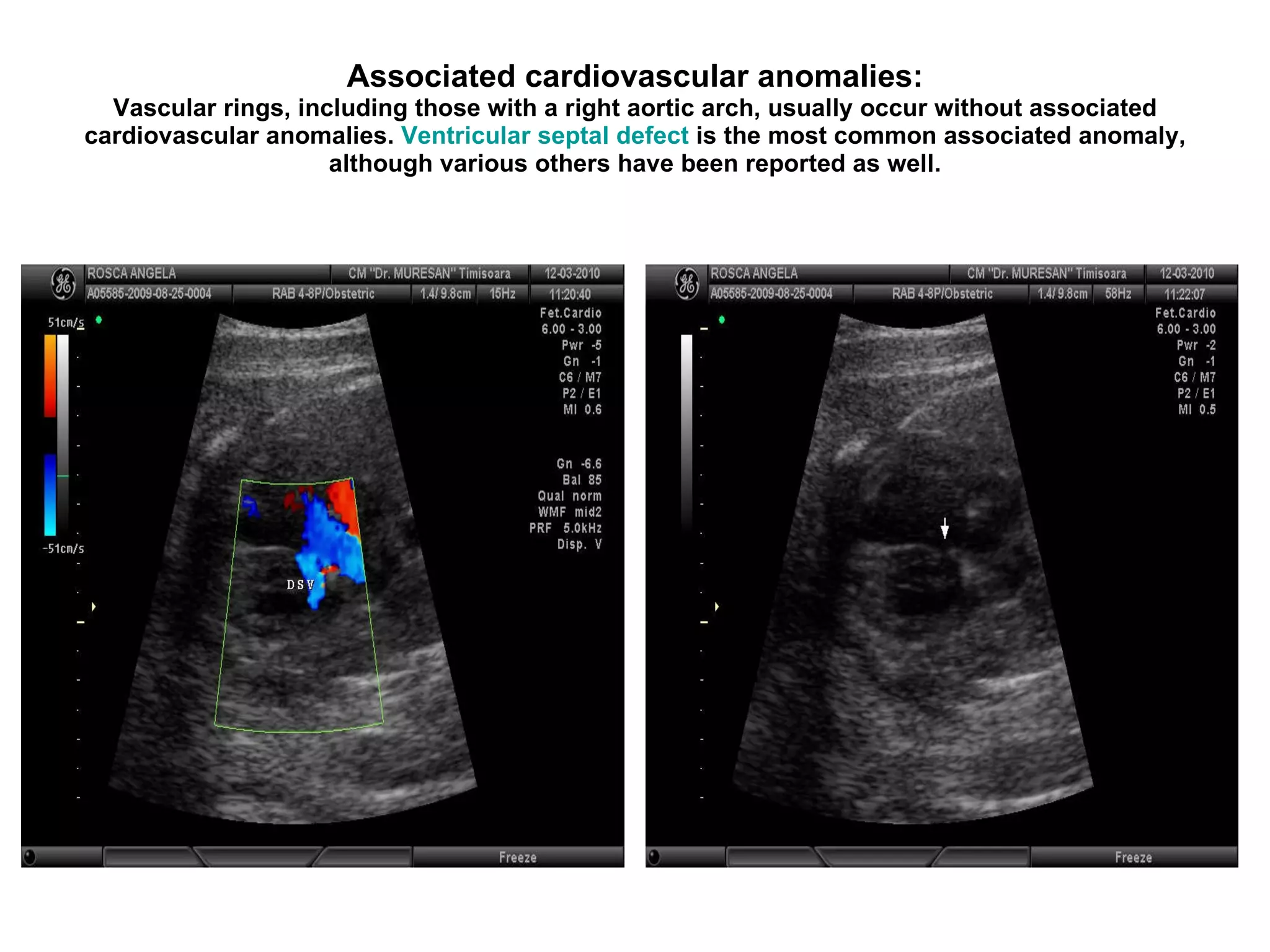 Vascular fetal anomaly -aortic arch anomalies | PPT | Heart and ...
