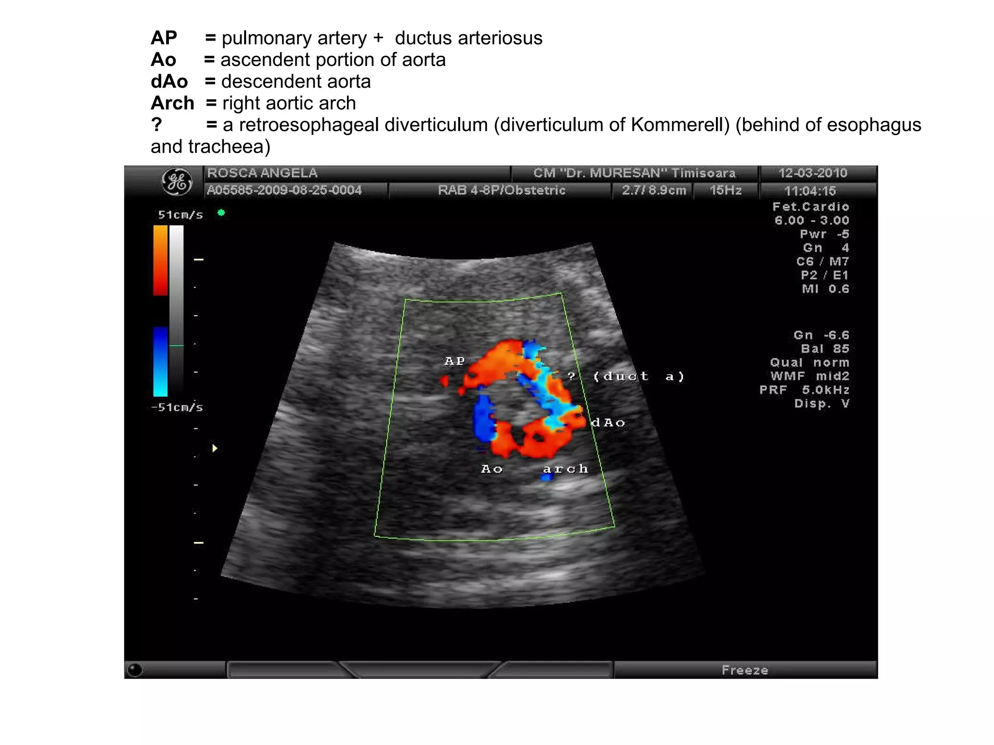 Vascular fetal anomaly -aortic arch anomalies | PPT