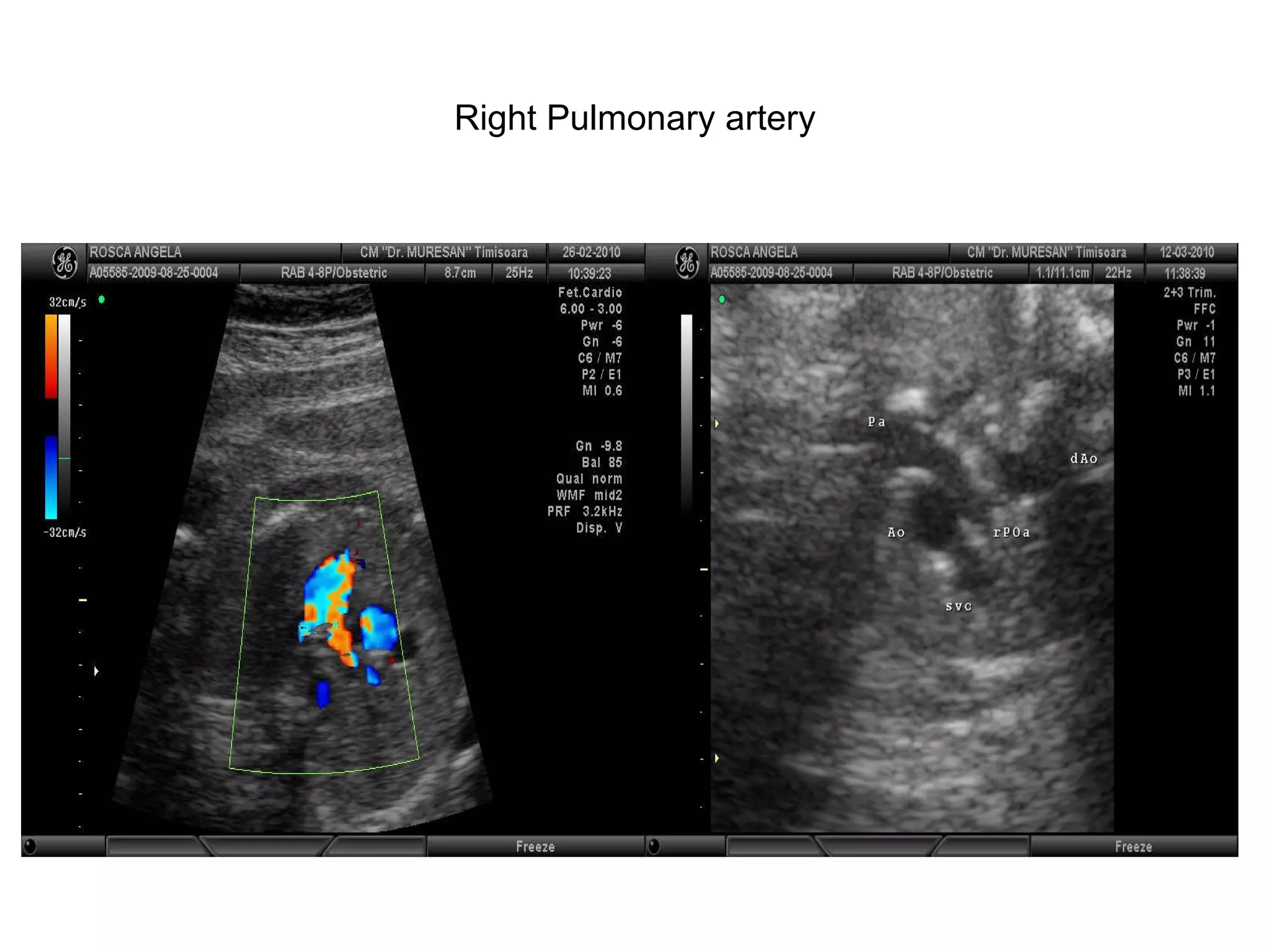 Vascular fetal anomaly -aortic arch anomalies | PPT | Heart and ...