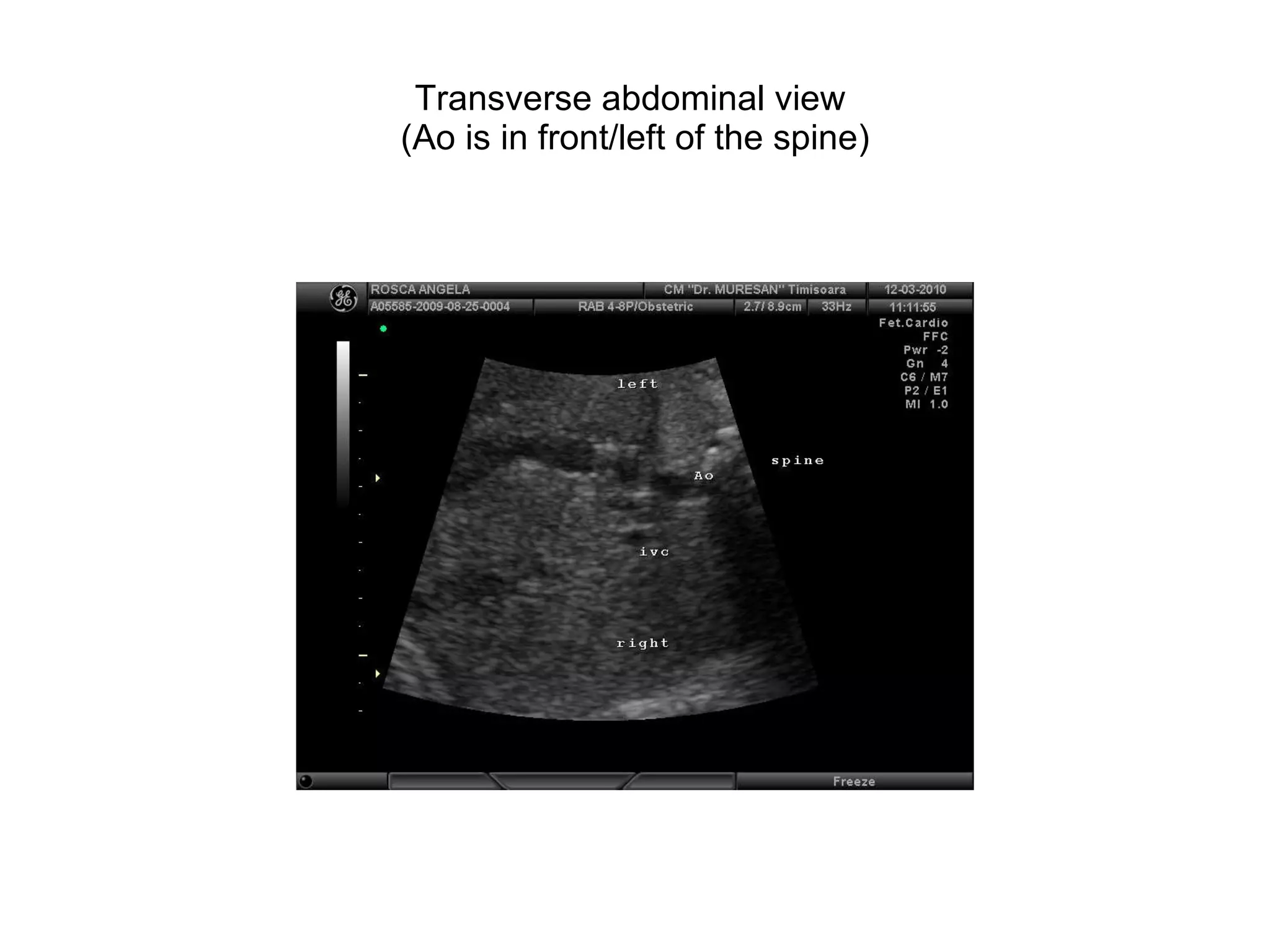 Vascular fetal anomaly -aortic arch anomalies | PPT