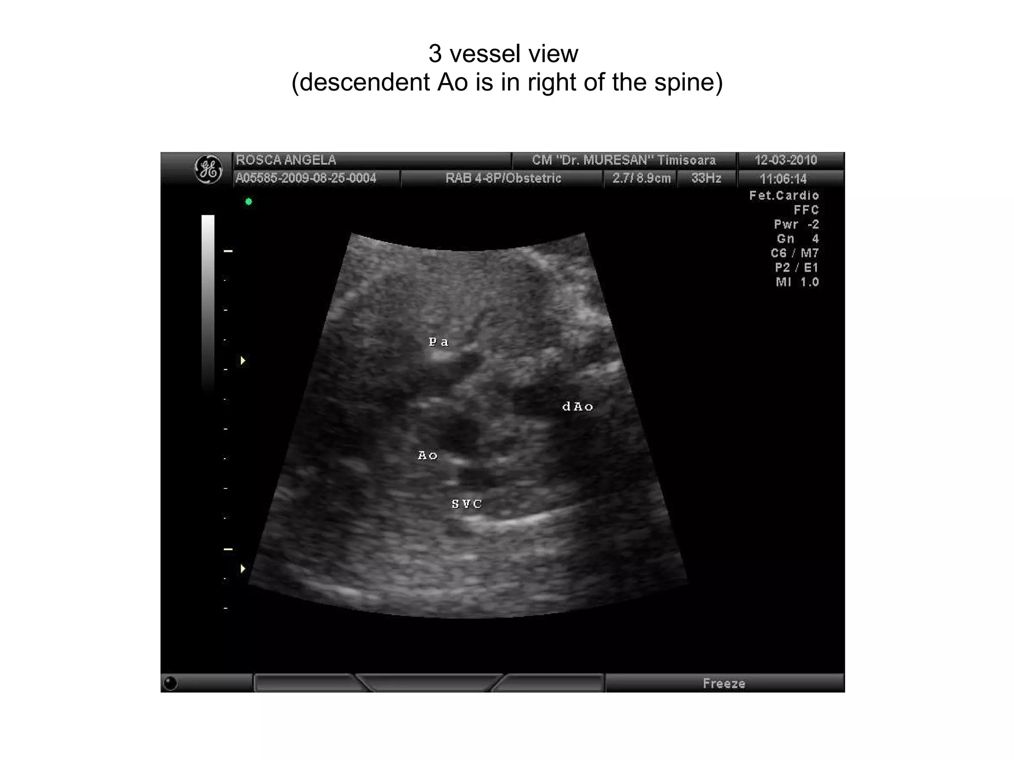 Vascular fetal anomaly -aortic arch anomalies | PPT | Heart and ...