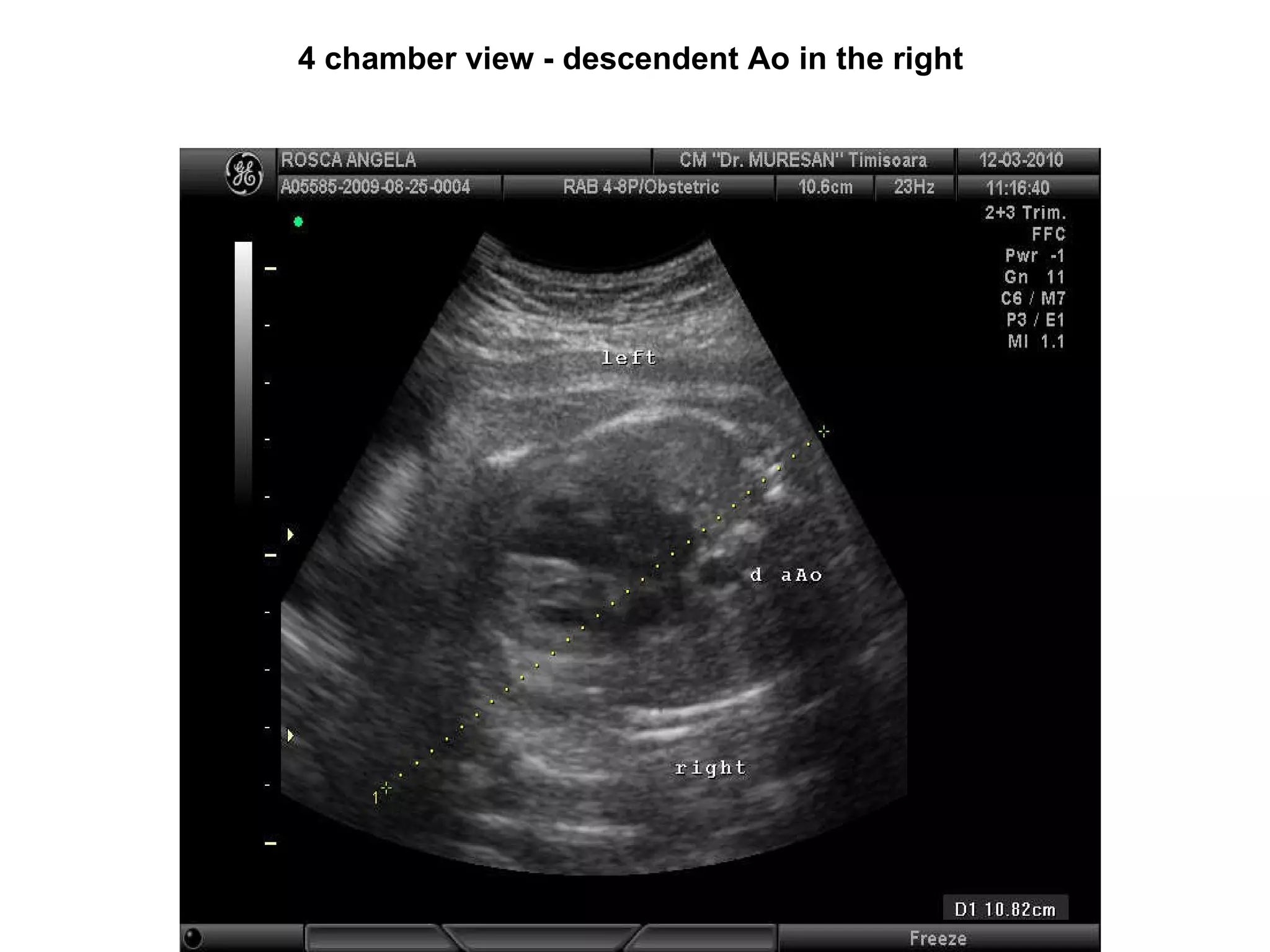 Vascular fetal anomaly -aortic arch anomalies | PPT | Heart and ...