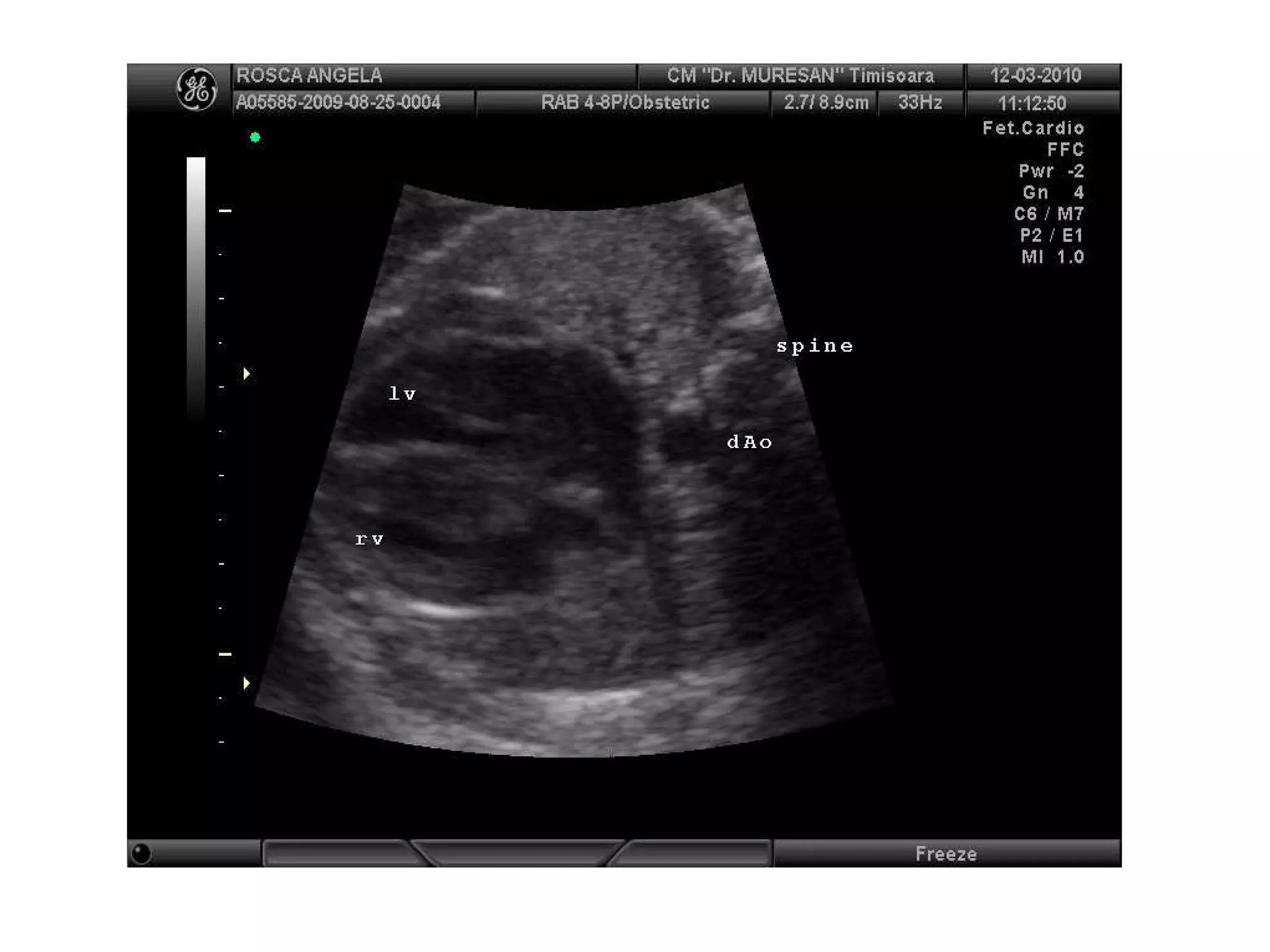 Vascular fetal anomaly -aortic arch anomalies | PPT | Heart and ...