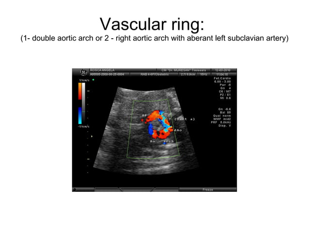 Vascular fetal anomaly -aortic arch anomalies | PPT | Heart and ...