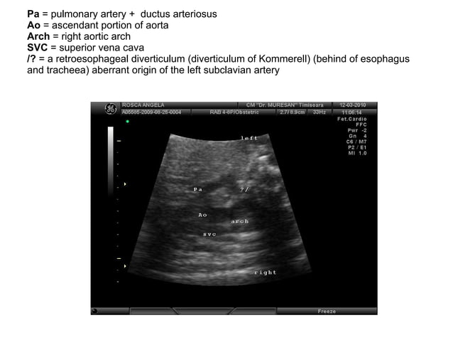 Vascular fetal anomaly -aortic arch anomalies | PPT | Heart and ...