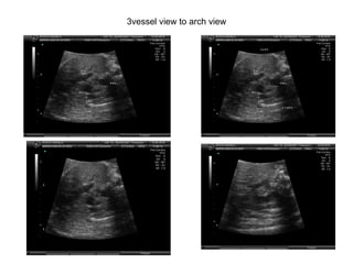 Vascular fetal anomaly -aortic arch anomalies | PPT | Heart and ...