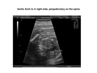 Vascular fetal anomaly -aortic arch anomalies | PPT | Heart and ...