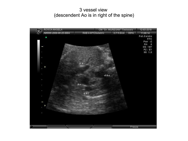 Vascular fetal anomaly -aortic arch anomalies | PPT | Heart and ...