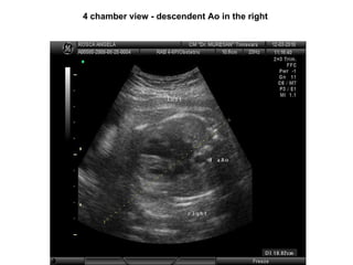 Vascular fetal anomaly -aortic arch anomalies | PPT | Heart and ...