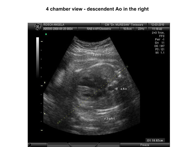 Vascular fetal anomaly -aortic arch anomalies | PPT | Heart and ...