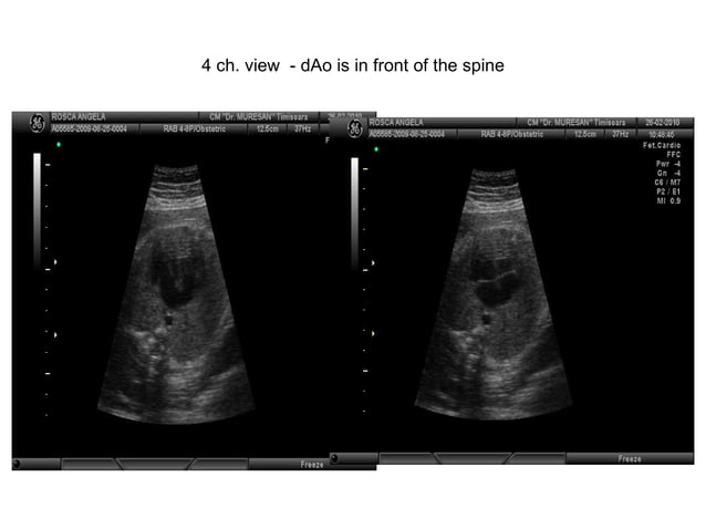 Vascular fetal anomaly -aortic arch anomalies | PPT | Heart and ...