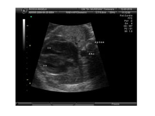 Vascular fetal anomaly -aortic arch anomalies | PPT | Heart and ...