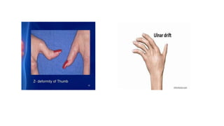 rheumatoid arthritis - ayurveda view (amavata) | PPTX