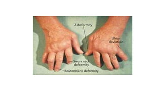 rheumatoid arthritis - ayurveda view (amavata) | PPTX