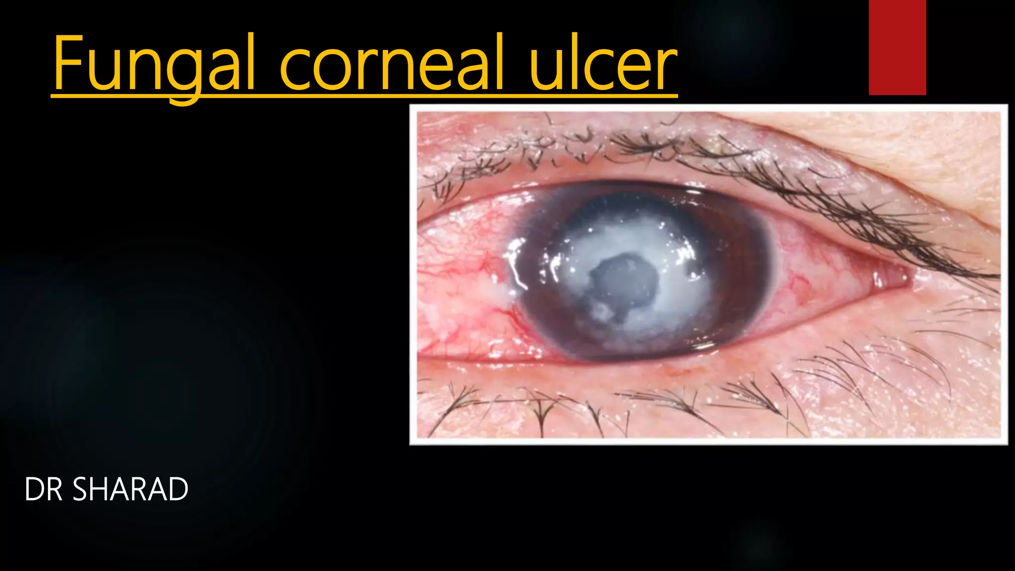 fungal / mycotic corneal ulcer power point presentation for O.A 2nd year students | PPTX