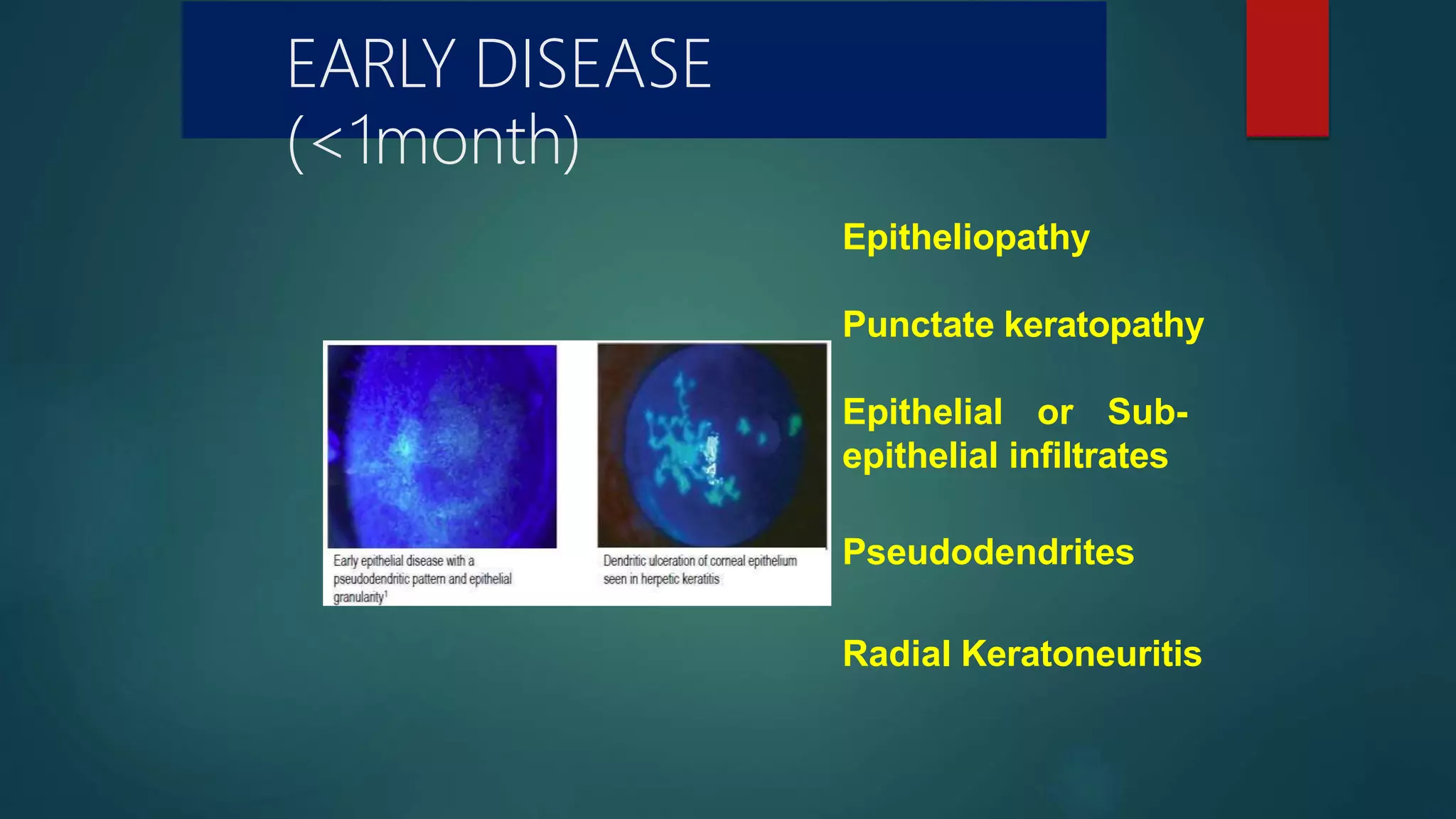 fungal / mycotic corneal ulcer power point presentation for O.A 2nd ...