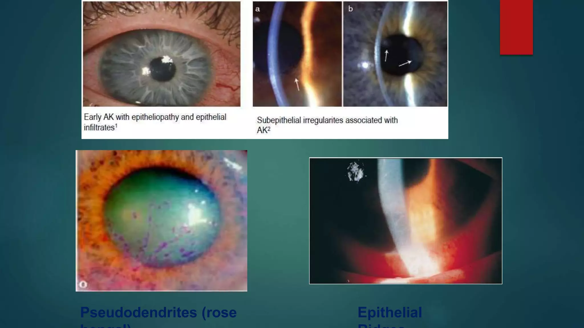 fungal / mycotic corneal ulcer power point presentation for O.A 2nd ...