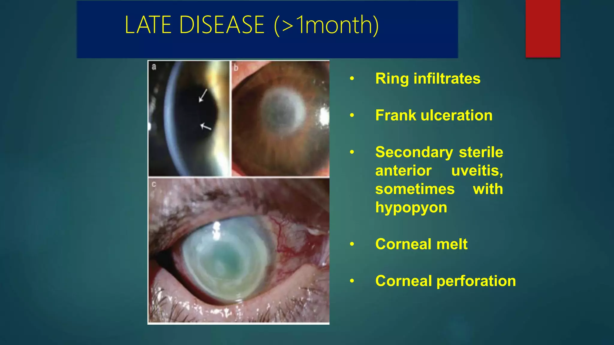 fungal / mycotic corneal ulcer power point presentation for O.A 2nd ...