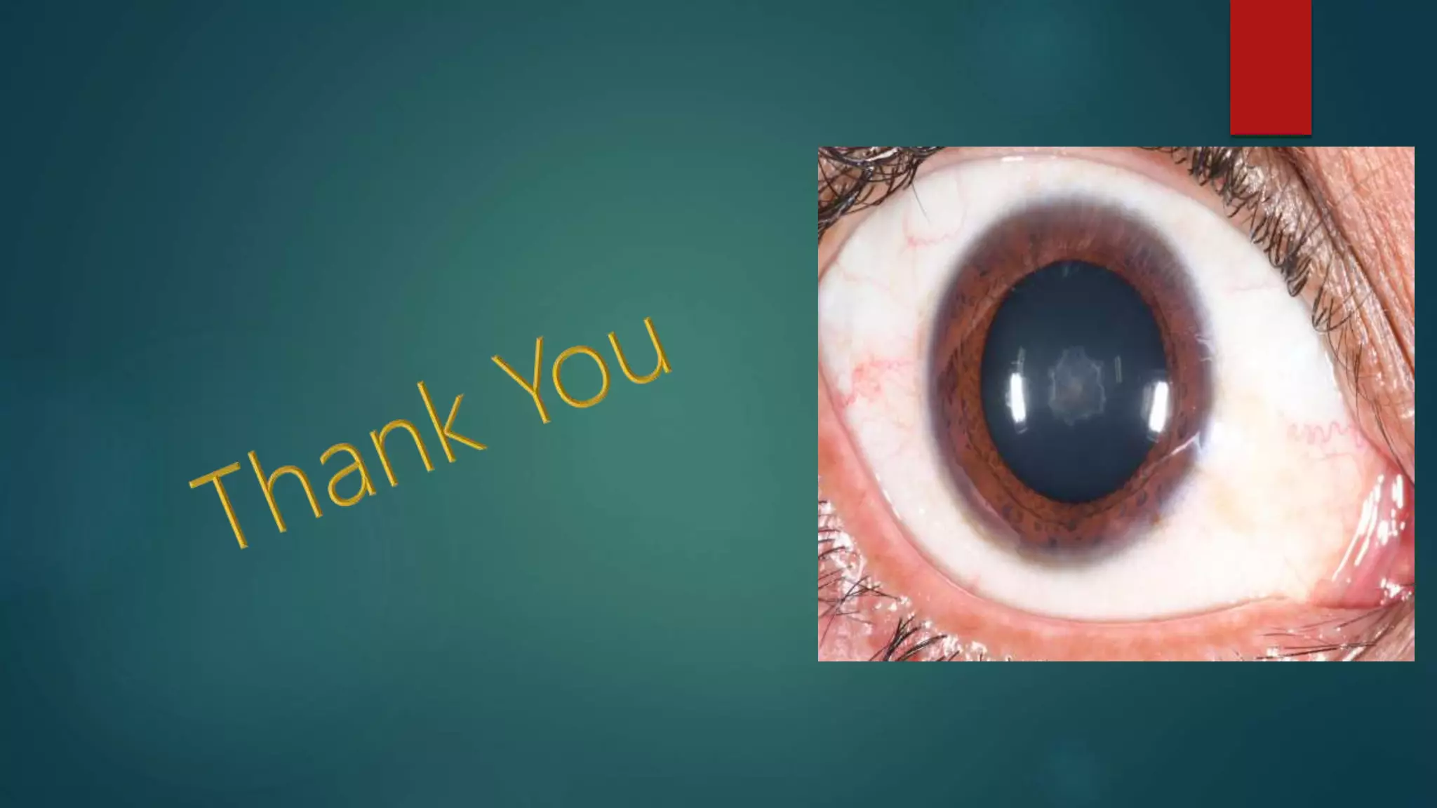 fungal / mycotic corneal ulcer power point presentation for O.A 2nd ...