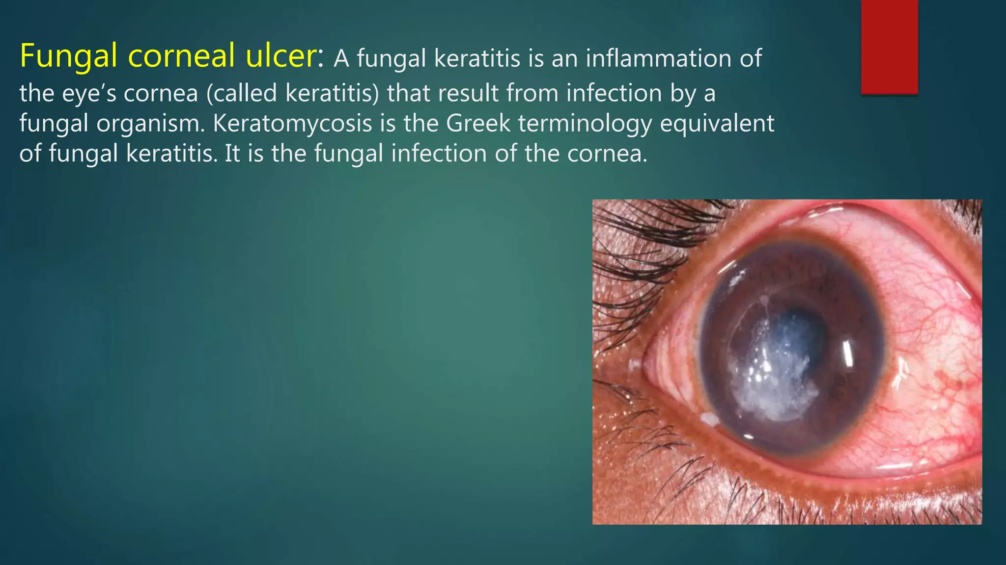 fungal / mycotic corneal ulcer power point presentation for O.A 2nd ...