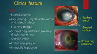 Fungal Corneal Ulcer Satellite Lesion