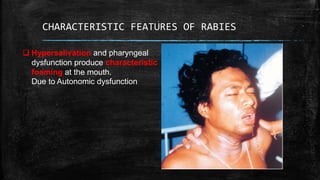 Human With Rabies Foaming
