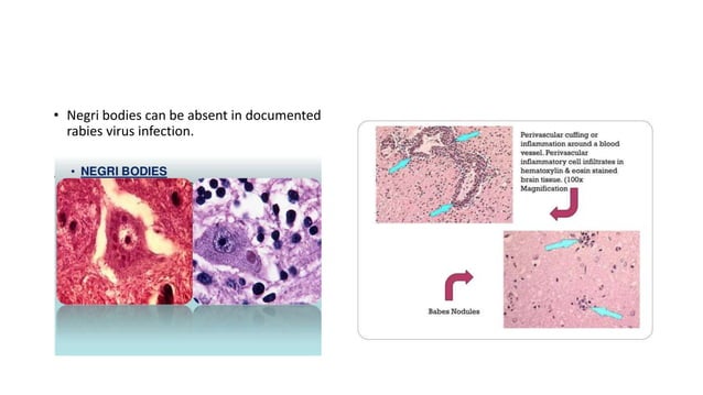 Rabies in Children | PPTX | Brain and Nervous System Disorders ...