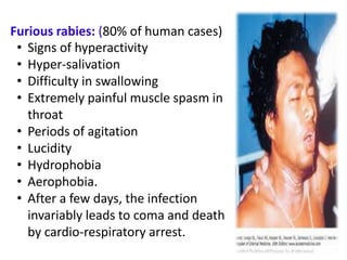 Aerophobia Rabies
