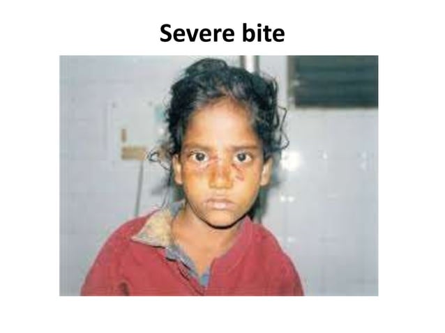 Rabies in children and preventive measures- world rabies day event 2014 ...