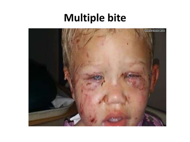 Rabies in children and preventive measures- world rabies day event 2014 ...