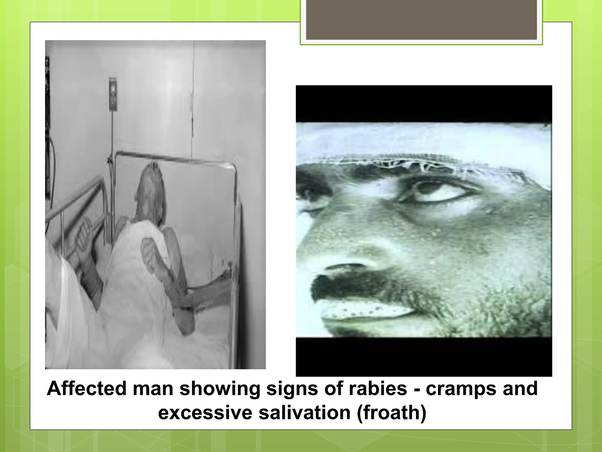 Rabies Pathology . Rabies causes treatment | PDF