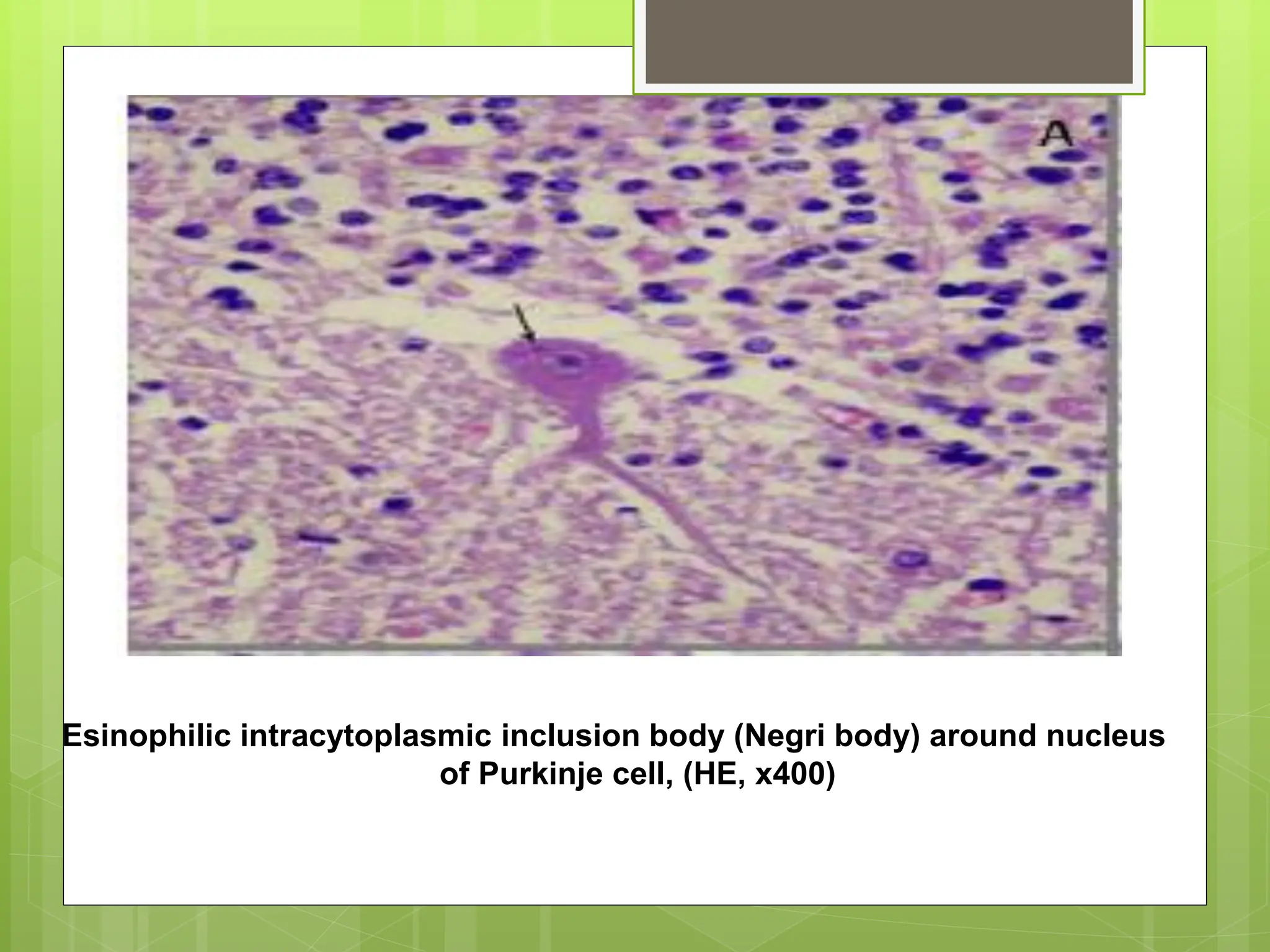 Rabies Pathology . Rabies causes treatment | PDF