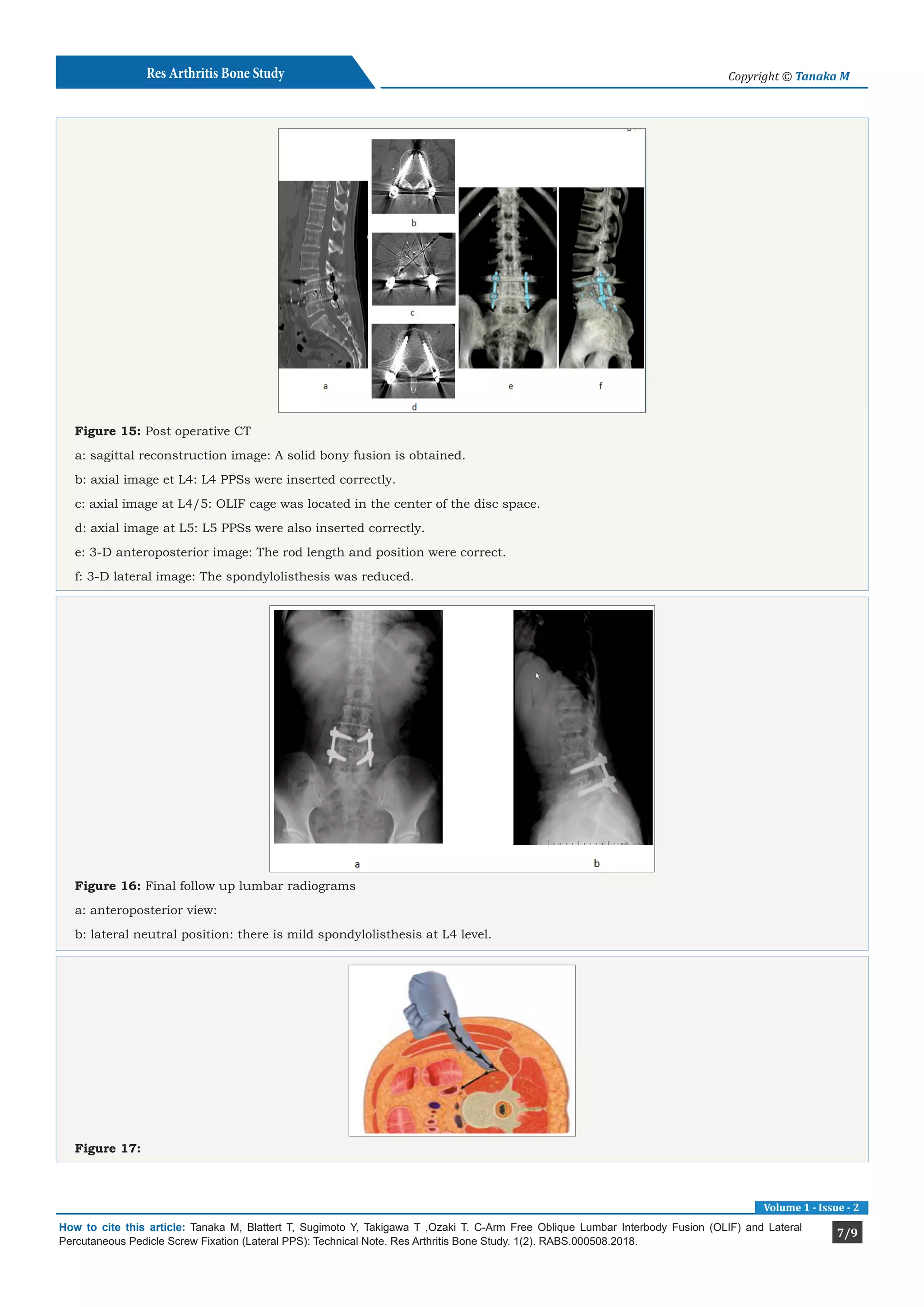 C-Arm Free Oblique Lumbar Interbody Fusion (OLIF) and Lateral ...