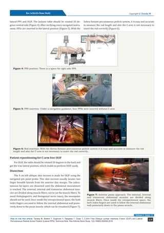 C-Arm Free Oblique Lumbar Interbody Fusion (OLIF) and Lateral ...