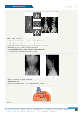 C-Arm Free Oblique Lumbar Interbody Fusion (OLIF) and Lateral ...