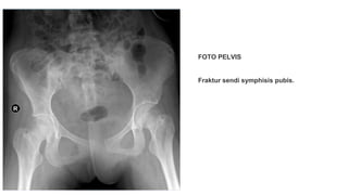 Rabu Klinik - Fraktur Pelvis.pdf