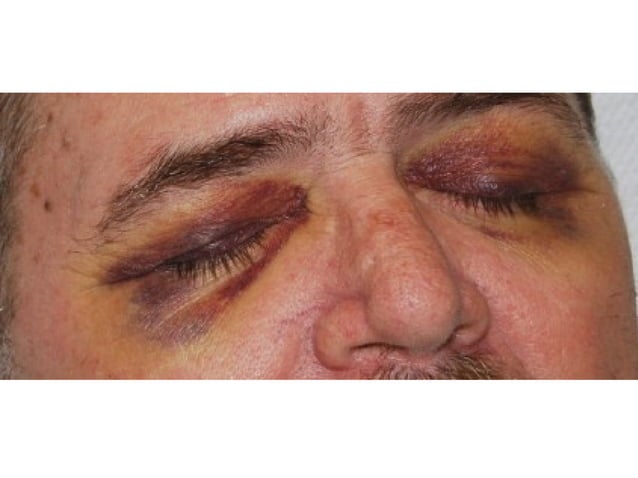 Raccoon eyes 2019 | PPT