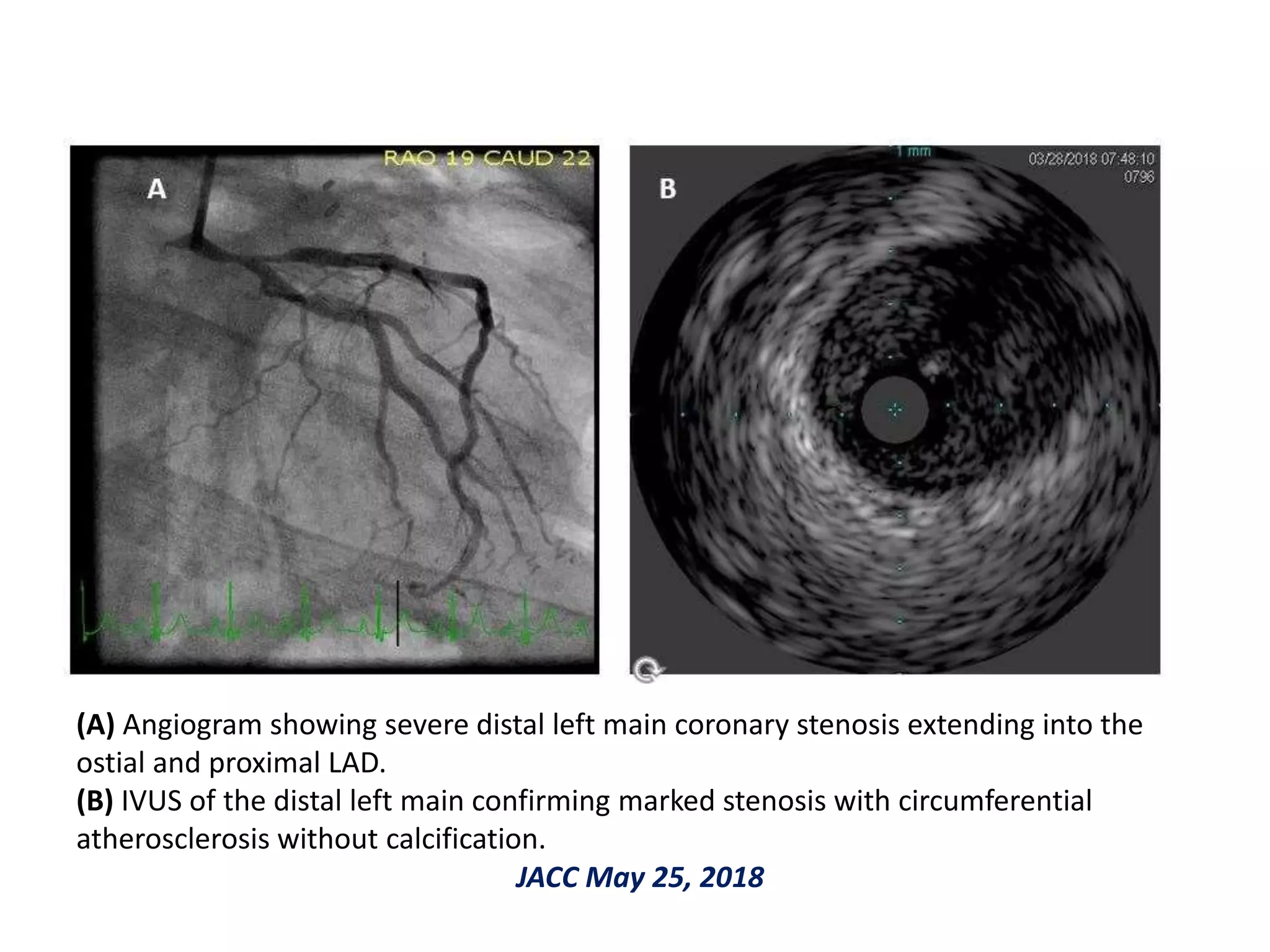 Radiation Associated Cardiac Disease | PPTX