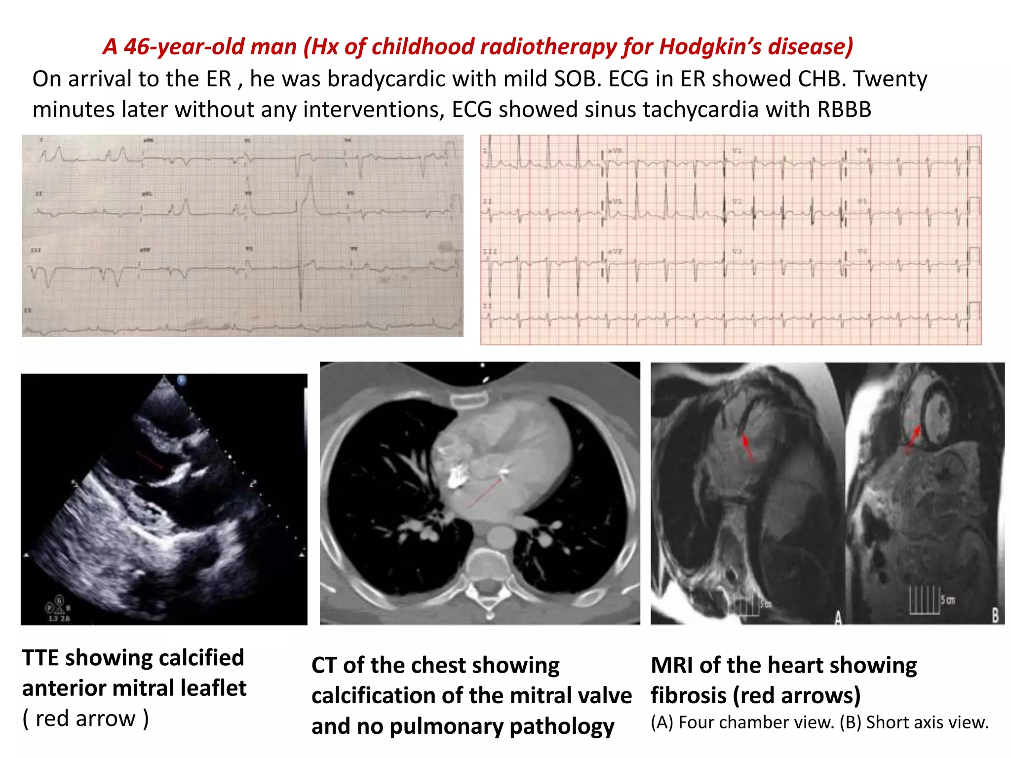 Radiation Associated Cardiac Disease | PPTX