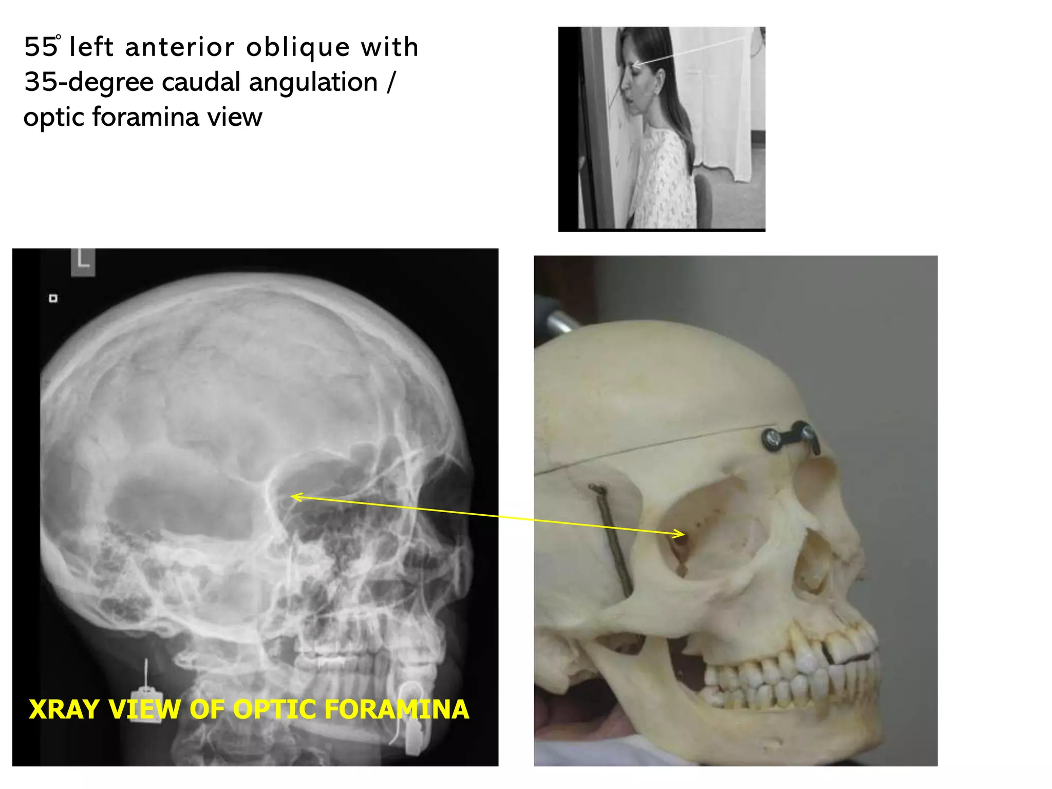 Radiological anatomy of the Head and Neck | PDF