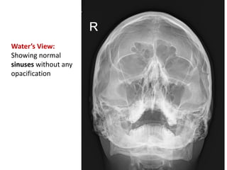 Radiological anatomy of the Head and Neck | PDF