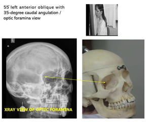 Radiological anatomy of the Head and Neck | PDF
