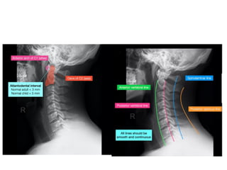 Radiological anatomy of the Head and Neck | PDF